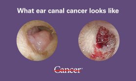 6208 - Malignant neoplasm of the ear (other than skin only) | Medical EPSS