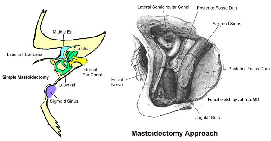 6200 - Chronic suppurative otitis media, mastoiditis, or cholesteatoma (or