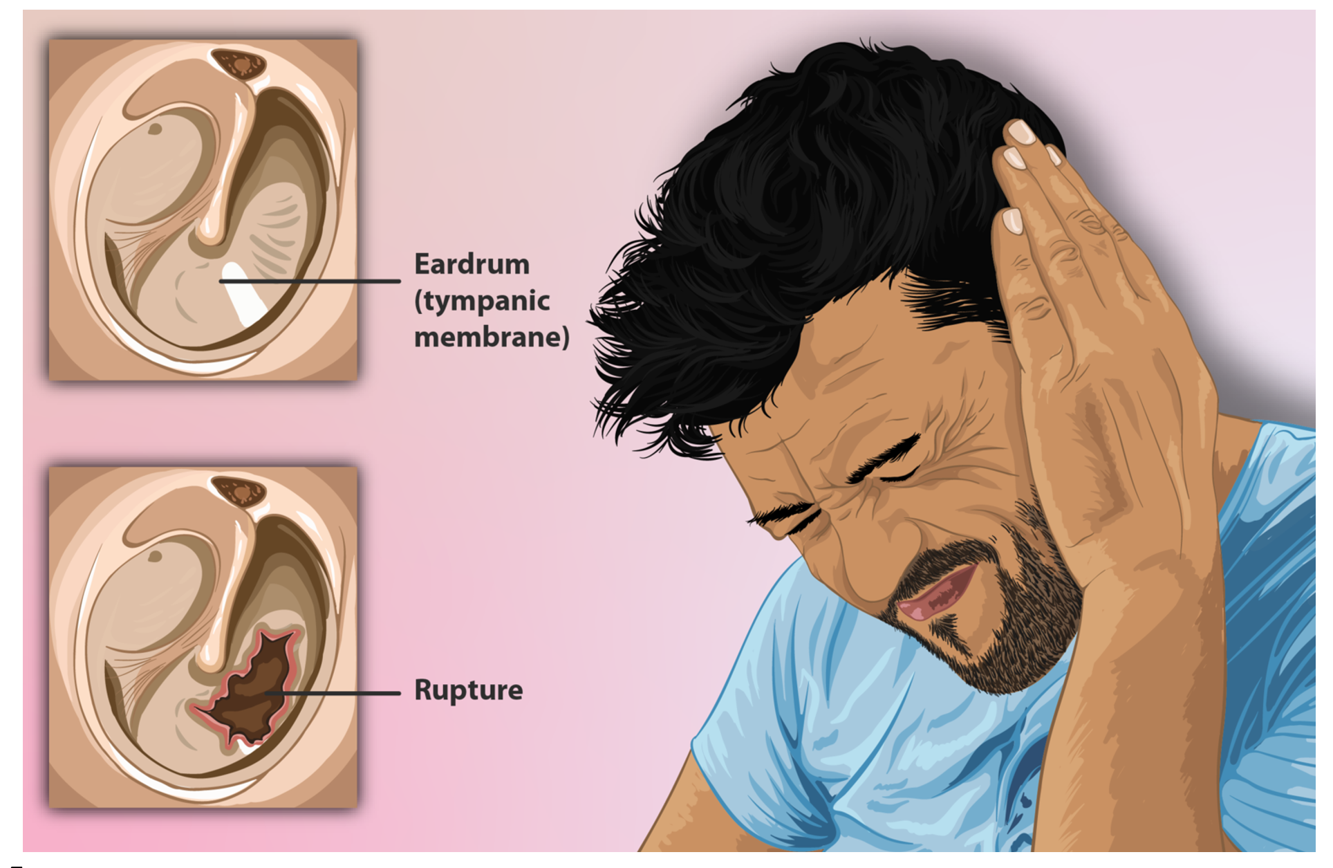 6200 - Chronic suppurative otitis media, mastoiditis, or cholesteatoma (or