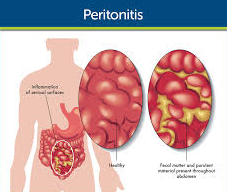 7301 - Peritoneum, adhesions of, due to surgery, trauma, or infection | Med