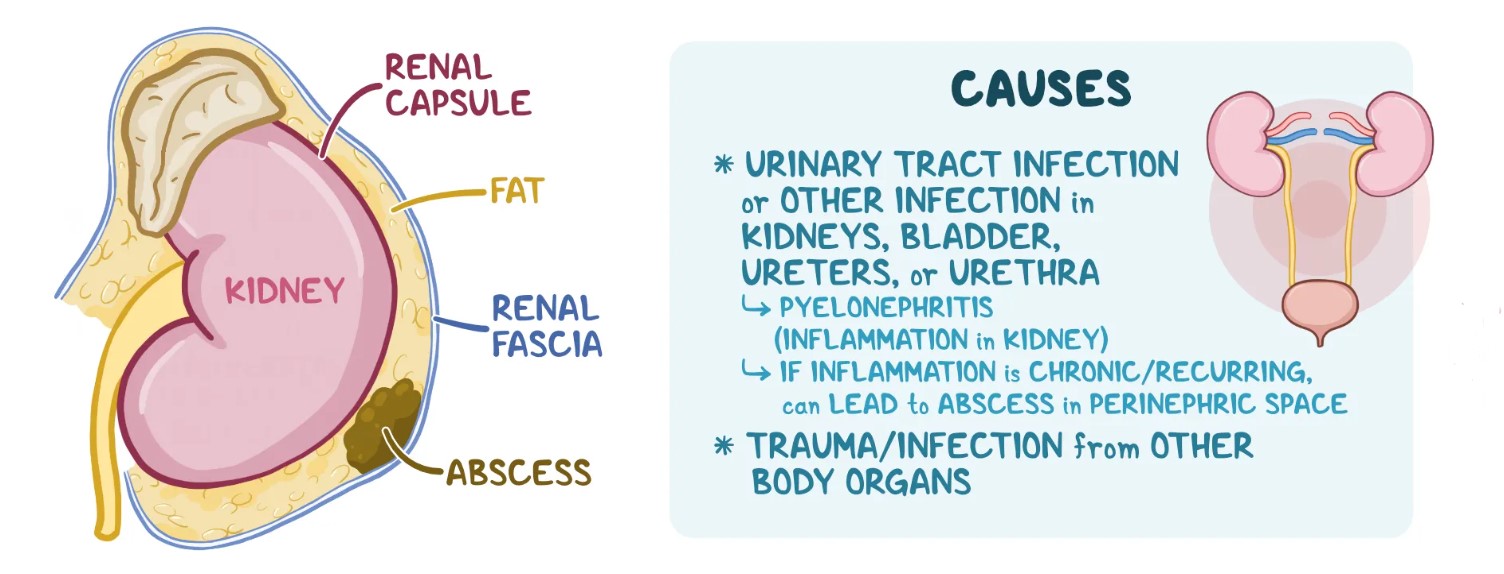 7501 - Kidney, abscess of | Medical EPSS