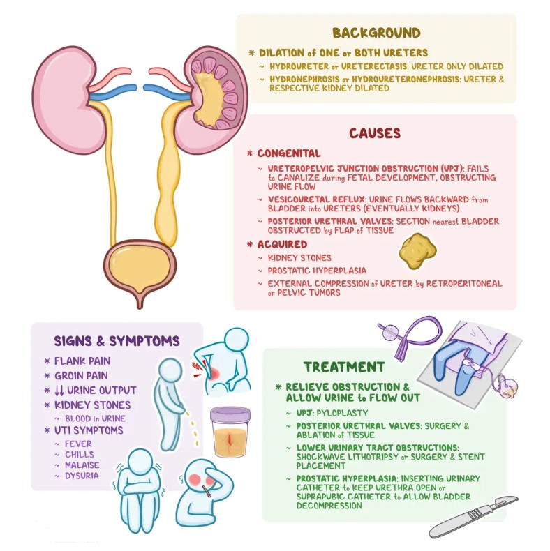7515 - Bladder, calculus in, with symptoms interfering with function | Medi