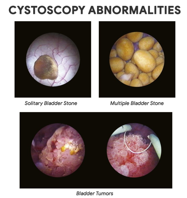 7515 - Bladder, calculus in, with symptoms interfering with function | Medi