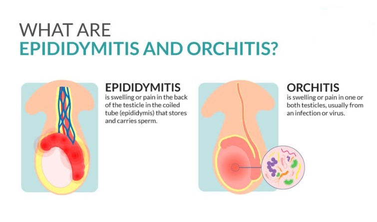 7525 - Epidiodymo-orchitis, chronic only | Medical EPSS