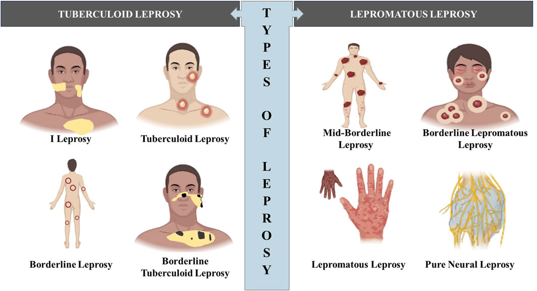 6302 - Leprosy (Hansen's disease) | MEPSS | Medical EPSS