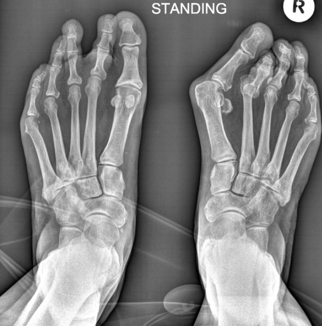 5280 - Hallux valgus, unilateral | MEPSS | Medical EPSS