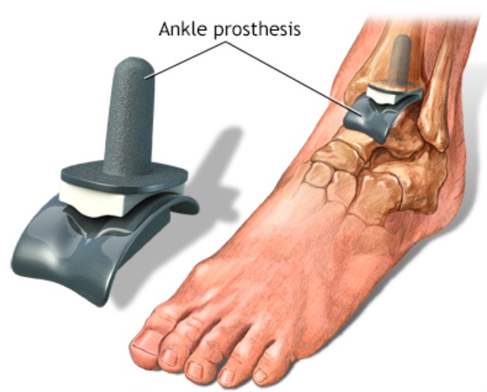 5274 - Astragalectomy | MEPSS | Medical EPSS