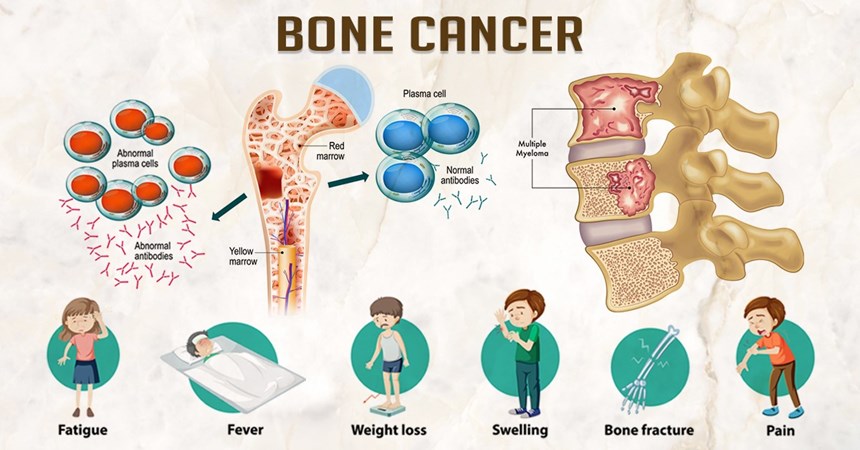 5012 - Bones, neoplasm, malignant, primary or secondary | MEPSS | Medical E