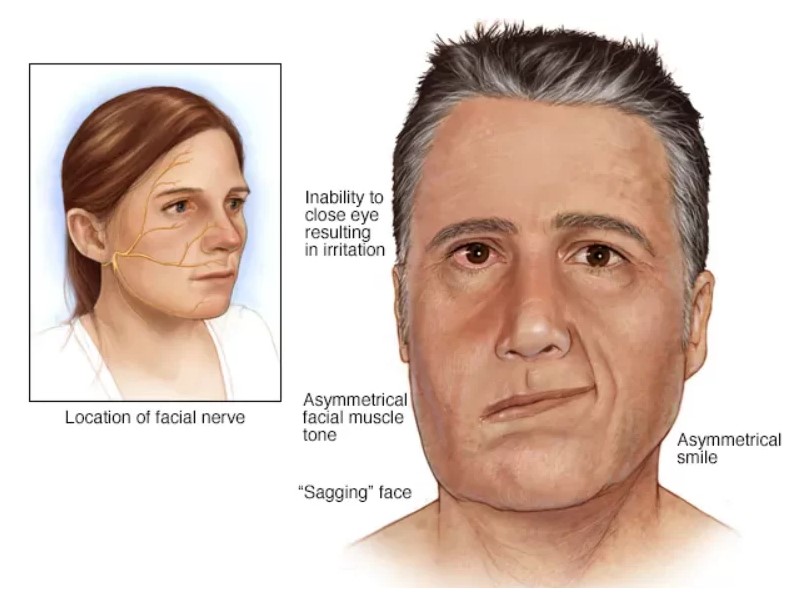 8005 - Bulbar palsy | Medical EPSS