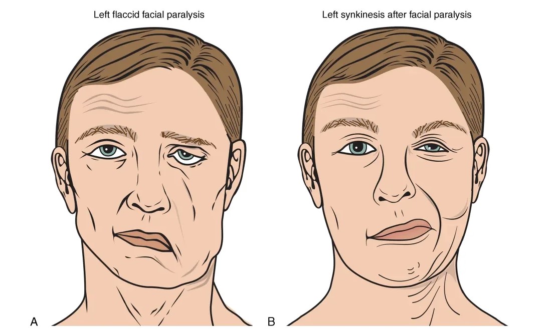 8024 - Syringomyelia | Medical EPSS