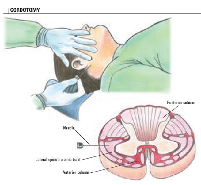 8024 - Syringomyelia | Medical EPSS