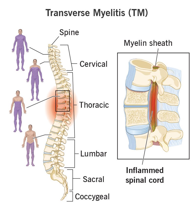 8010 - Myelitis | Medical EPSS