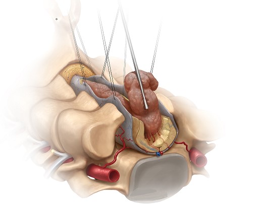 8024 - Syringomyelia | Medical EPSS