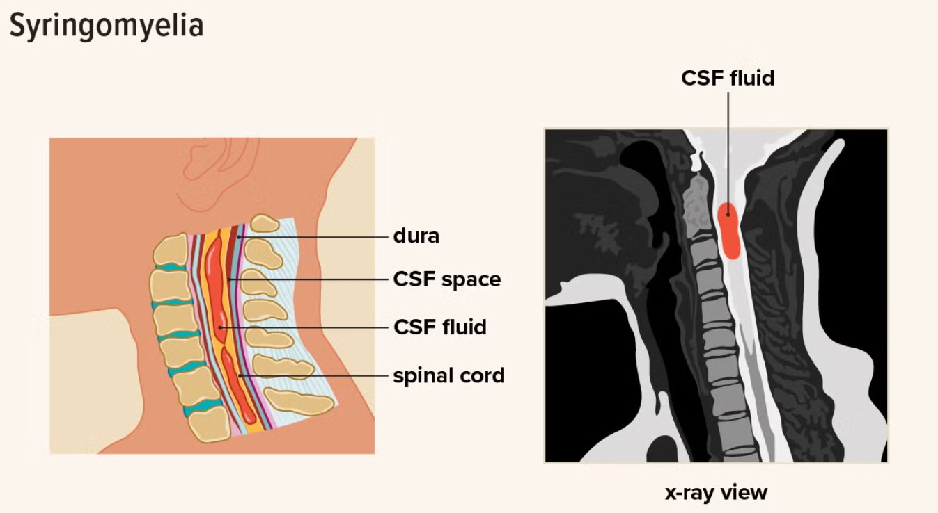 8024 - Syringomyelia | Medical EPSS