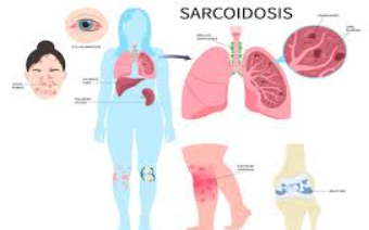 6846 - Sarcoidosis | Medical EPSS