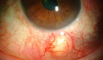 6002 - Scleritis | Medical EPSS