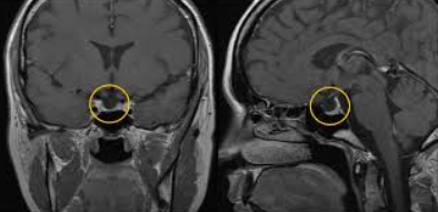 6046 - Post-chiasmal disorders | Medical EPSS