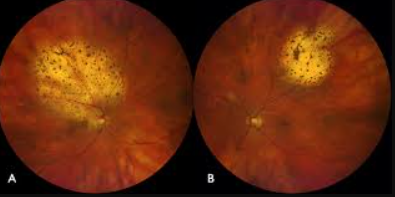 6046 - Post-chiasmal disorders | Medical EPSS