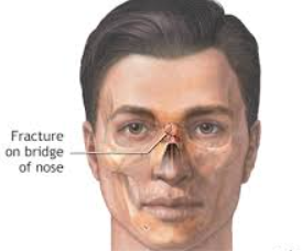 6599-6502 Fracture, nose | Medical EPSS