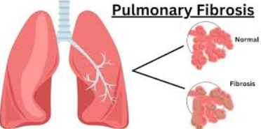 6899-6825 Fibrosis, pulmonary/Peribronchial fibrosis | Medical EPSS