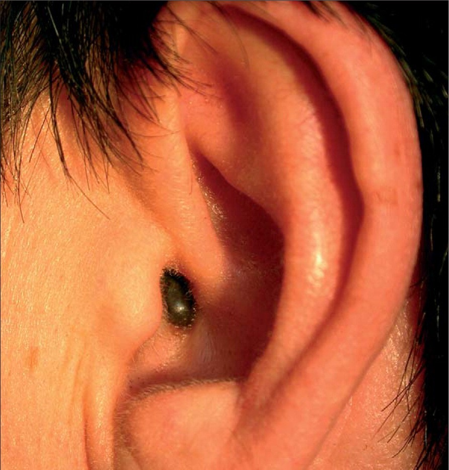 6208 - Malignant neoplasm of the ear (other than skin only) | Medical EPSS