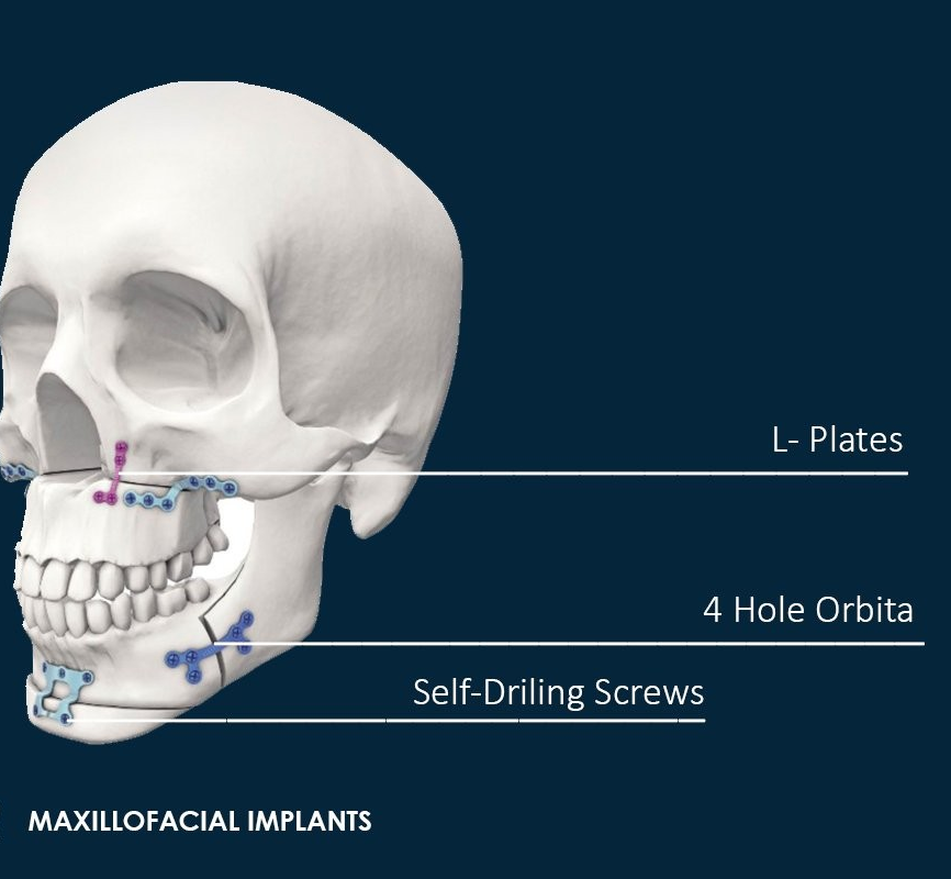 9914 - Maxilla, loss of more than half | Medical EPSS