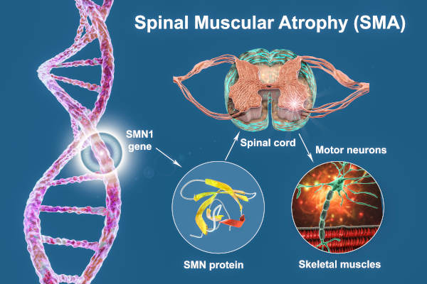 8023 - Progressive muscular atrophy | Medical EPSS