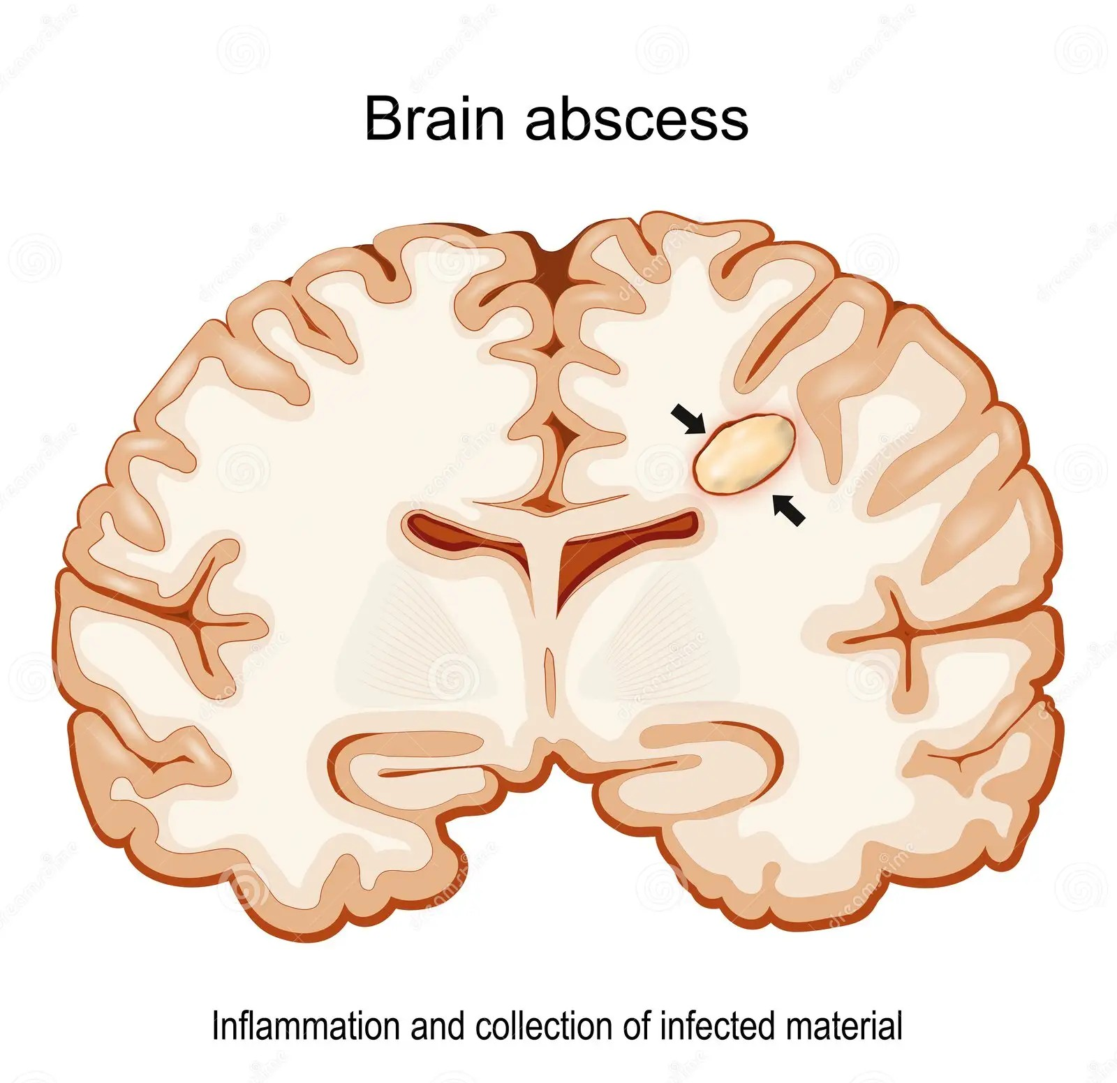 8020 - Brain, abscess of | Medical EPSS