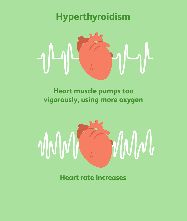 7008 - Hyperthyroid heart disease | Medical EPSS