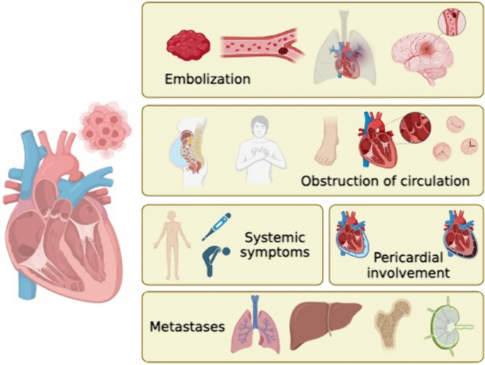 7123 - Soft tissue sarcoma (of vascular origin) | Medical EPSS