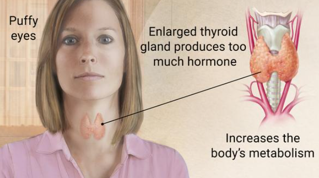 7008 - Hyperthyroid heart disease | Medical EPSS