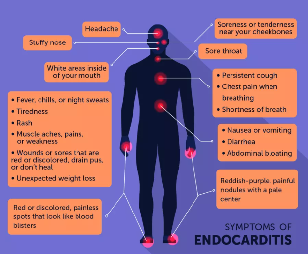 7001 - Endocarditis | Medical EPSS