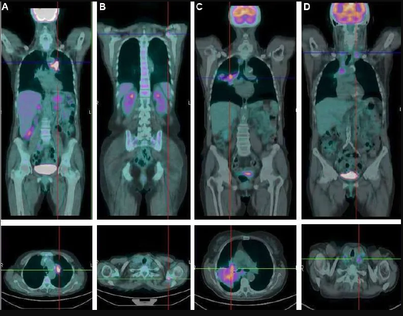 5012 - Bones, neoplasm, malignant, primary or secondary | MEPSS | Medical E